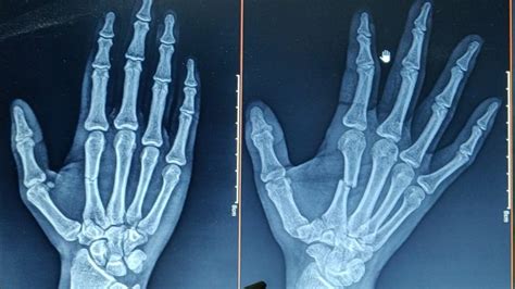 Displaced Fracture 2nd Metacarpal Ortho Homexray Bestbxraylab Youtube
