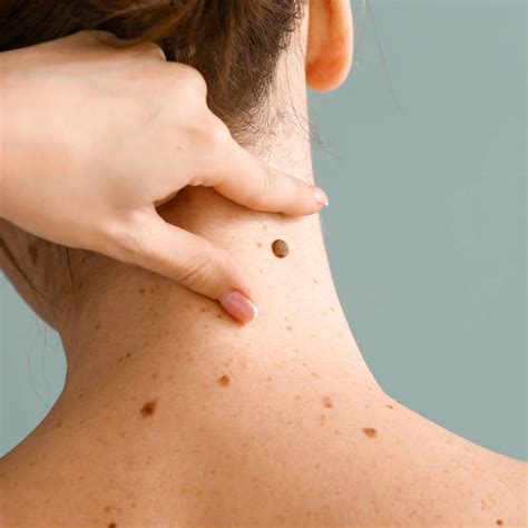 Mole Screening Beyond Skin