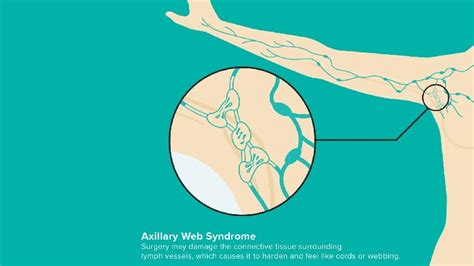 Axillary Web Syndrome Symptoms Causes And Treatments Page 3 Entirely Health