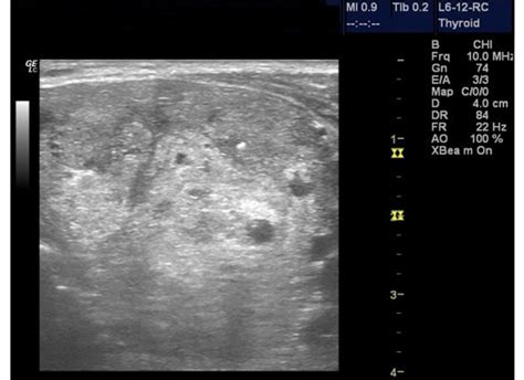 A Heterogeneous Nodule With Punctate Calcification Download