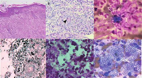 Histopathologic And Cytopathologic Diagnosis A Skin Section With Download Scientific Diagram