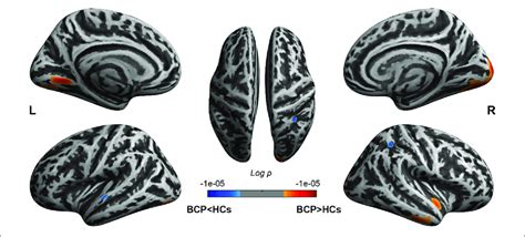 Brain Regions Show Ct Differences Between Bcp And Hcs The Thicker Download Scientific