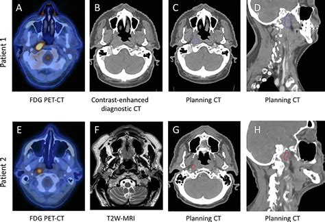 Incidence And Patterns Of Retropharyngeal Lymph Node Involvement In