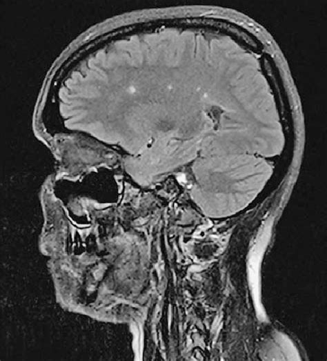 Sagittal T1 Mri Section After 7 Months Multiple Demyelinating Lesions