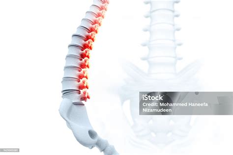 Hernie Der Lendenwirbelsäule Wirbelsäulenfraktur Und Traumatische