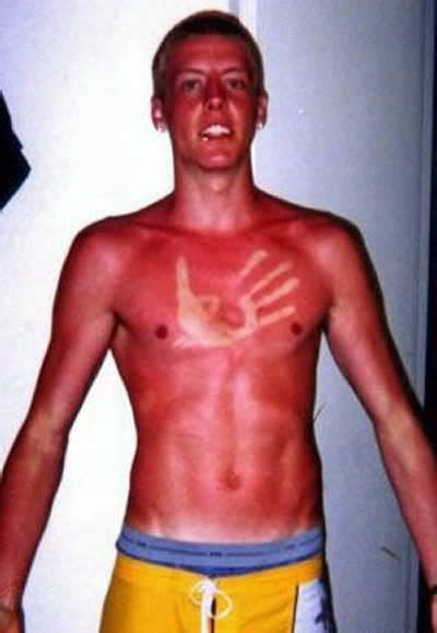 10 Hilarious Examples Of Sun Tans Gone Very Wrong
