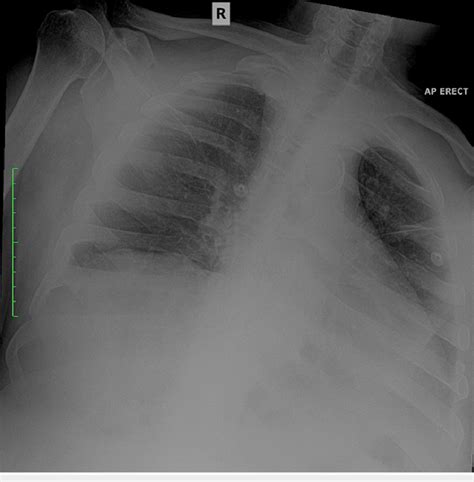 Chest Radiograph On Admission Demonstrating Bilateral Basal Lung