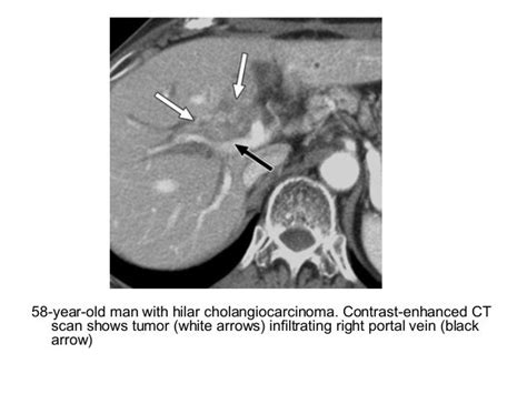 Diagnostic Imaging Of Cholangiocarcinoma