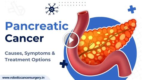 Pancreatic Cancer Causes Symptoms And Treatment Options