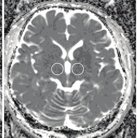 Pdf Csf Pulsation Artifacts On Adc Maps Obtained With Readout Segmented Epi