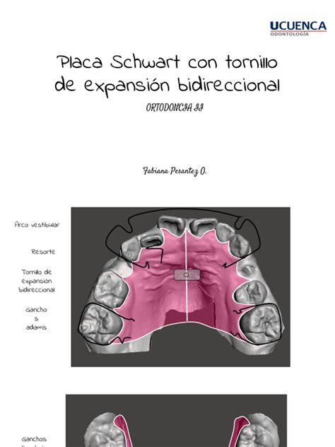 Placa Schwartz Con Tornillo Bidireccional Pdf