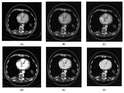 Diagnostics Free Full Text Dual Energy Ct In Cardiothoracic Imaging Current Developments