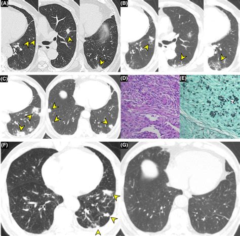 A Initial High Resolution Computed Tomography Hrct Shows Nodular Download Scientific