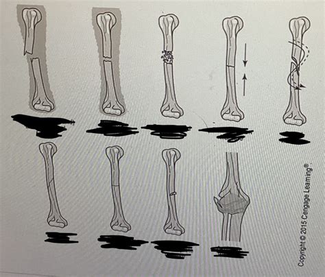 Bone Fractures Diagram Quizlet