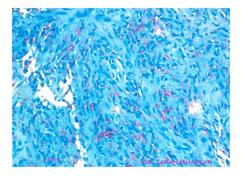 Genevieve Crane Md Phd On Twitter Beautiful Example Of Mycobacterial Spindle Cell