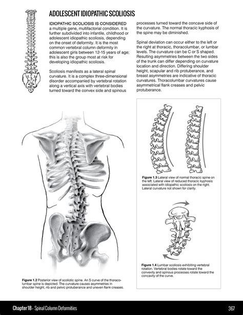 Convex And Concave Side Of Scoliosis Mapasgmaes