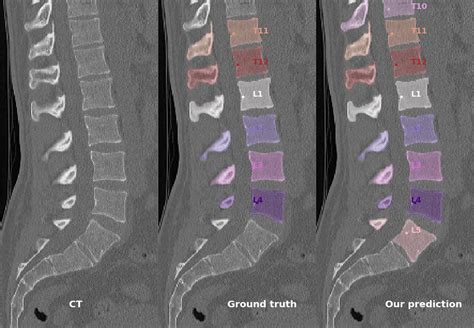 Issues · Spine Vertebraesegmentation · Gitlab