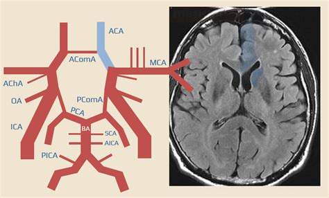 Posterior Cerebral Artery Stroke Illustration Of “homoregional
