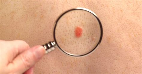 Easy Abcde Method To Check For Moles And Identify Skin Cancer