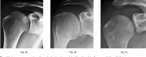 Figure From The Instability Severity Index Score A Simple Pre Operative Score To Select