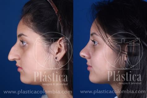 Overprojected Nasal Tip Technique To Decrease The Nasal Tip Projection