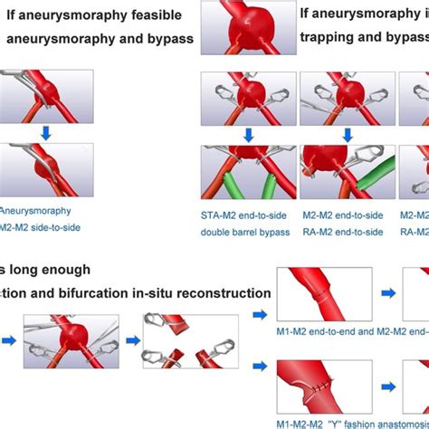 Systematic Illustration Showing Preoperative Strategies In Different
