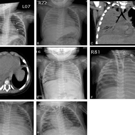 Patients Baseline Characteristics And Primary Diagnosis For Ecmo