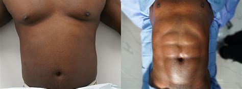 Case 2460 Patient Results Abdominal Etching Before And After Photos Avana Plastic Surgery
