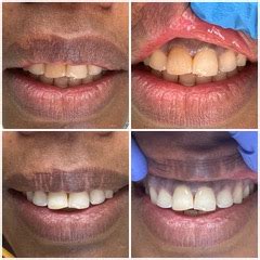Dentist In Castle Rock Co Smile Gallery Founders Dental Before And After