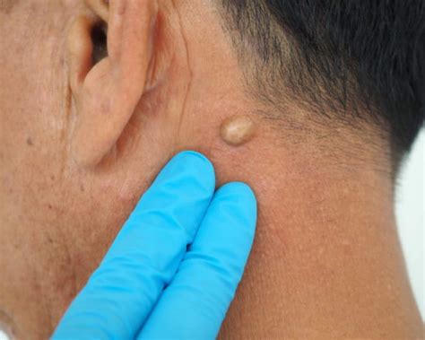 Epidermoid Cyst