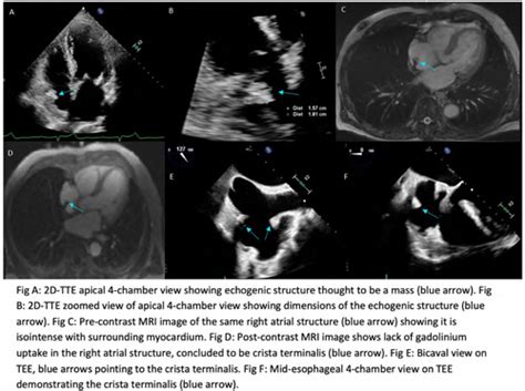 Crista Terminalis Mri