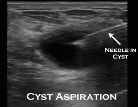 Breast Cyst Ultrasound