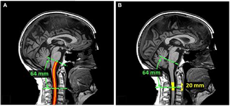 Frontiers Automatic Measure And Normalization Of Spinal Cord Cross Sectional Area Using The