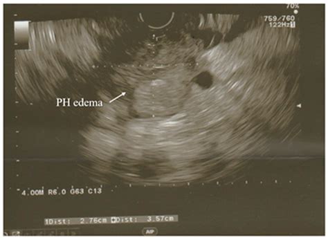 Pancreatitis
