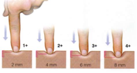 Glomerular Diseases Flashcards Quizlet
