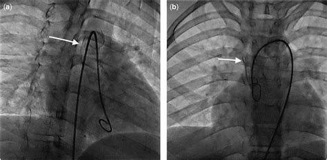 Figure1 A And B Aortic Calcification Of The Ascending Aorta And Download Scientific Diagram
