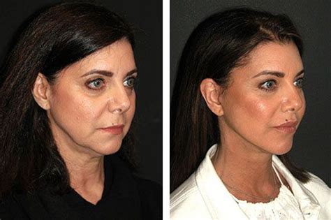 A Temporal Brow Lift Is A Minimally Invasive Surgical Procedure That Dr
