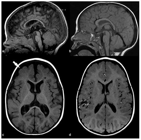 Cor T2 Mri Of Brain