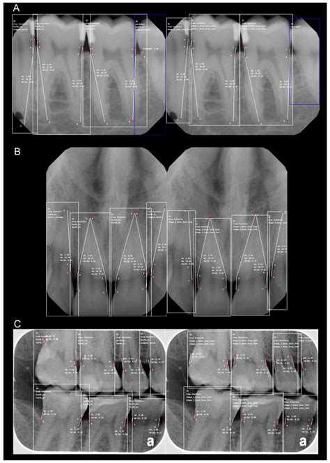 Automatic Detection Of Radiographic Alveolar Bone Loss In Bitewing And