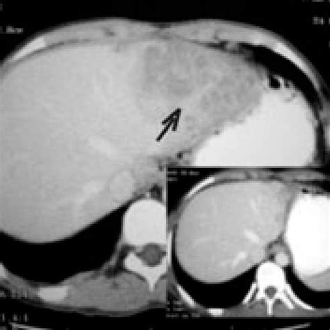 Pdf Hepatic Tuberculosis In Absence Of Disseminated Abdominal
