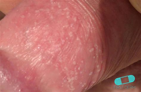 Candidiasis Cutaneous Candidiasis First Derm