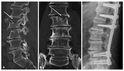Lumbar Spine Ct A Sagittal Section Osteolytic Lesions In L3 And L4 Download Scientific