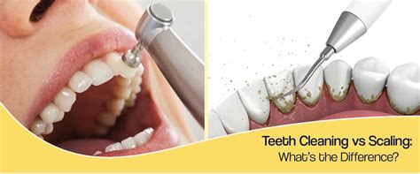 Teeth Cleaning Vs Scaling Whats The Difference