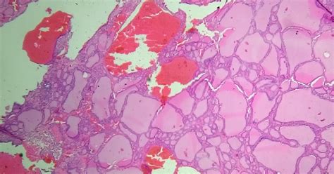 Understanding Pathology Dr Pranav Pramod Patwardhan Multinodular Goiter