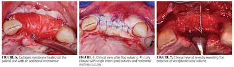Rescuing A Smile With A Ridge Augmentation And Implant Rehabilitation
