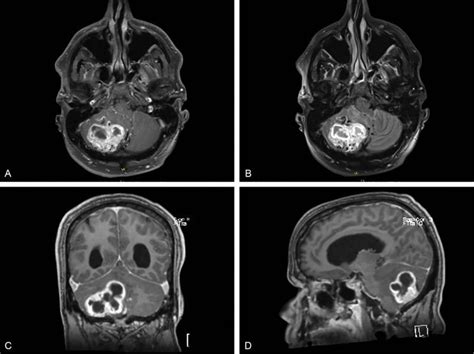 Suboccipital Craniotomy Clinical Tree