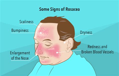 Flushing Causes Symptoms And Treatment
