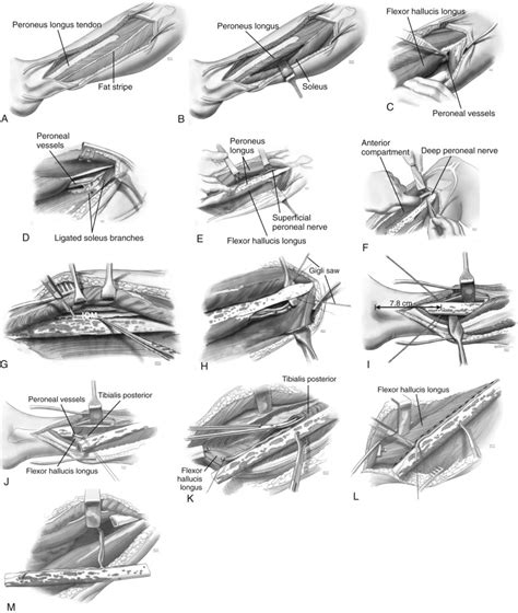 Vascularized Bone Grafting Musculoskeletal Key