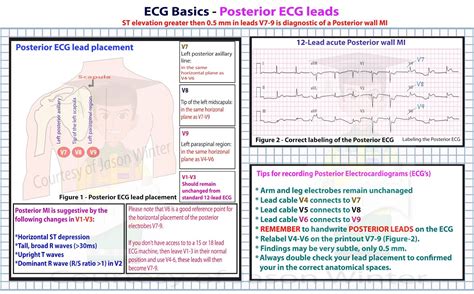 Normal 12 Lead Ecg Labeled Normal 12 Lead Ecg Labeled