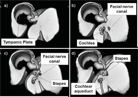 Tympanic Plate Of Temporal Bone The Anatomy Of The Middle Ear